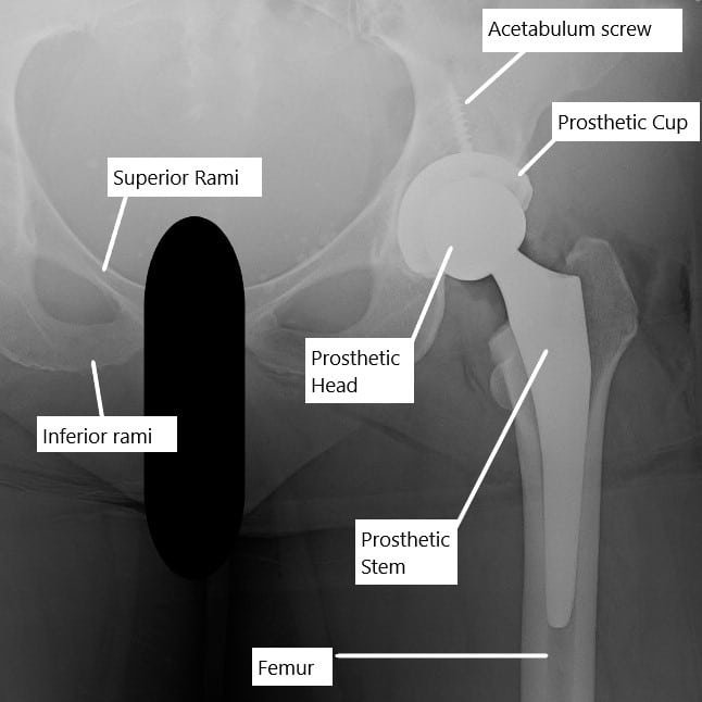 Pain After Hip Replacement - Complete Orthopedics & Podiatry Pain After Hip Replacement - Complete Orthopedics & Podiatry